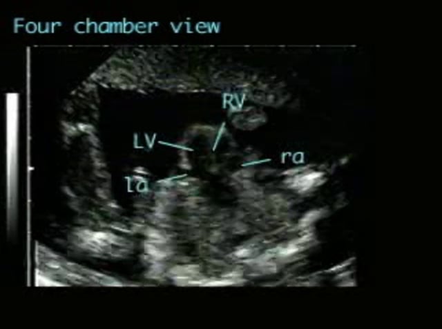 Ectopia cordis – ULTRASOUNDPAEDIA