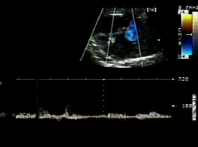 Pulmonary valve – atresia – ULTRASOUNDPAEDIA