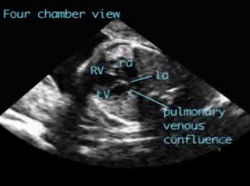 Total anomalous pulmonary venous connection (TAPVC) coronary sinus ...