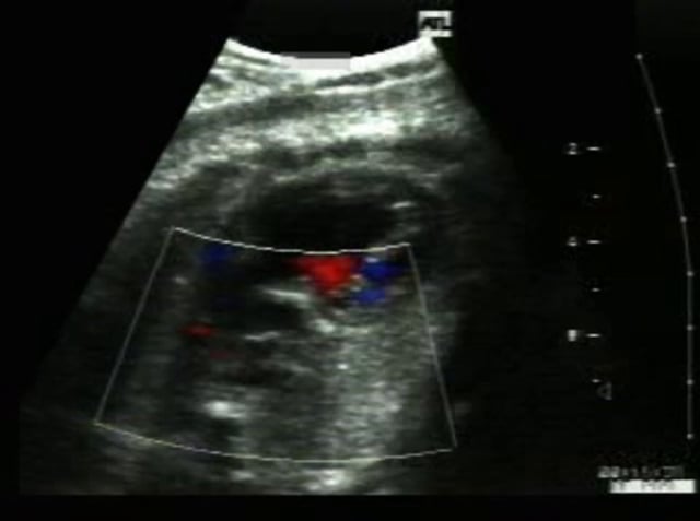 Right atrial – isomerism – ULTRASOUNDPAEDIA