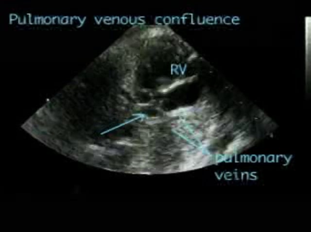 Total anomalous pulmonary venous connection (TAPVC) supracardiac ...