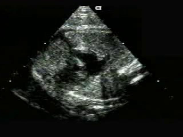 Aorta – interrupted arch – ULTRASOUNDPAEDIA