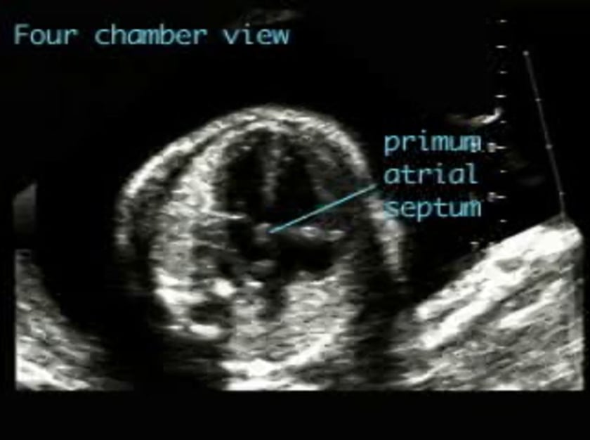 Ventricular septal defect – ULTRASOUNDPAEDIA