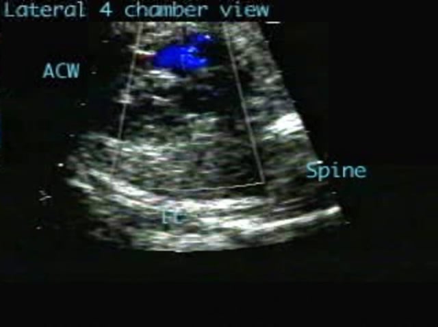 Ventricular septal defect – ULTRASOUNDPAEDIA