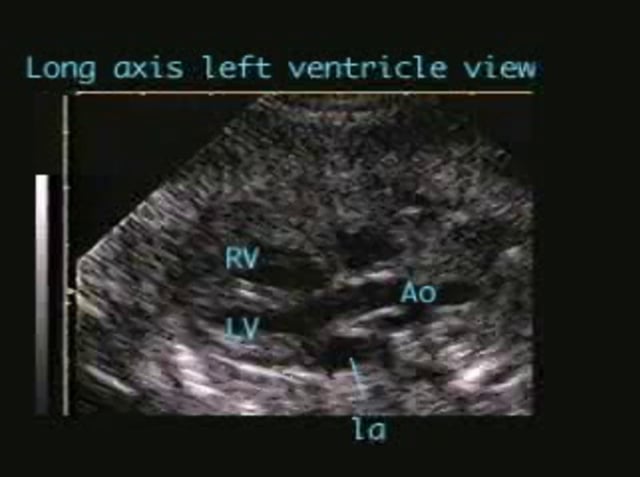 Ventricular septal defect – ULTRASOUNDPAEDIA
