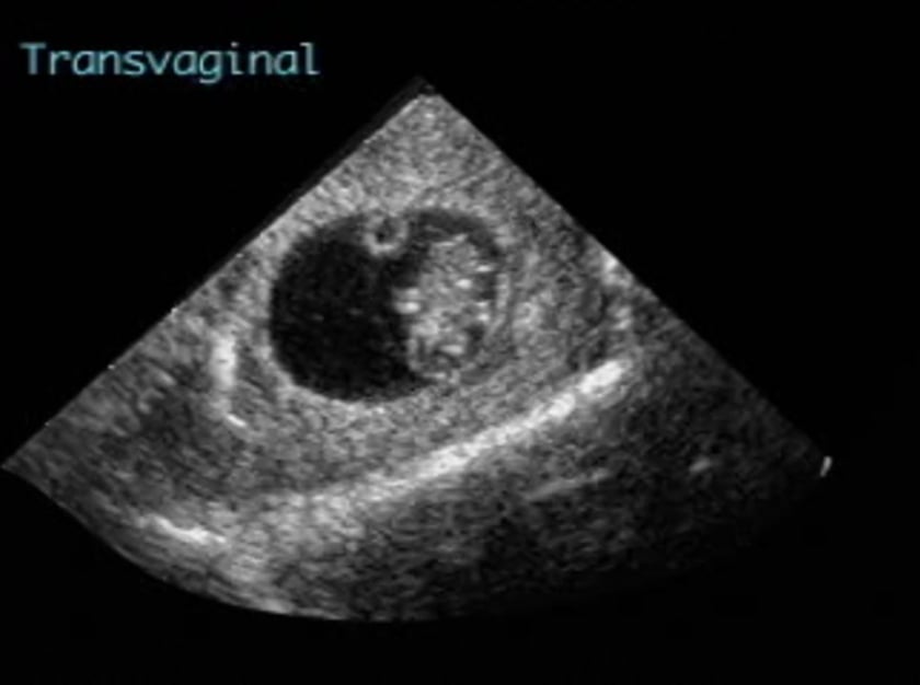 Omphalocele (Exomphalos) – ULTRASOUNDPAEDIA