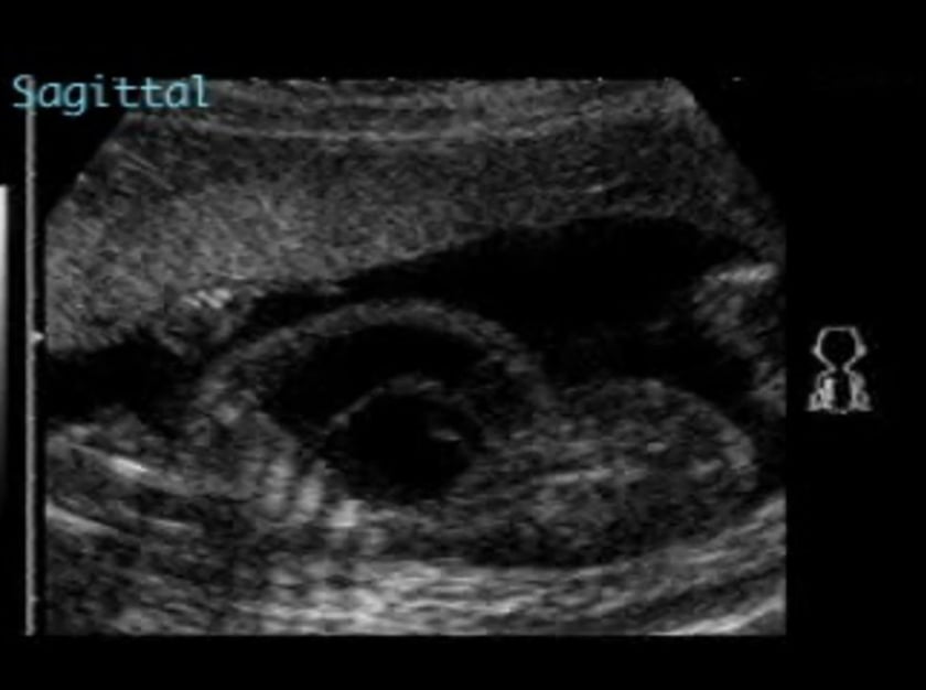 Hepatic cyst – ULTRASOUNDPAEDIA