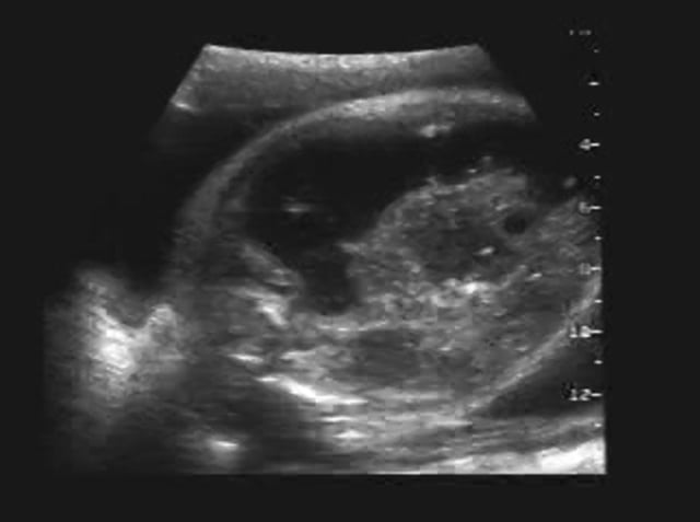Imperforate anus – ULTRASOUNDPAEDIA