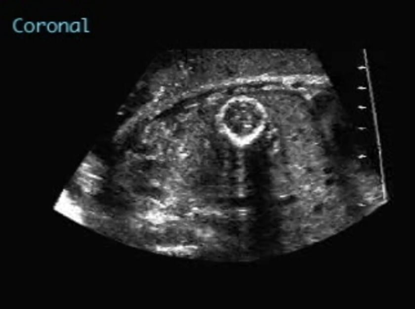 Intestinal duplication – ULTRASOUNDPAEDIA