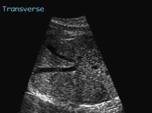 Intestinal perforation – ULTRASOUNDPAEDIA