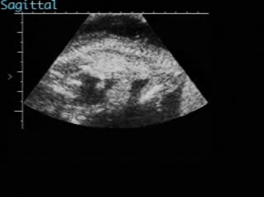 Pentalogy of Cantrell – ULTRASOUNDPAEDIA