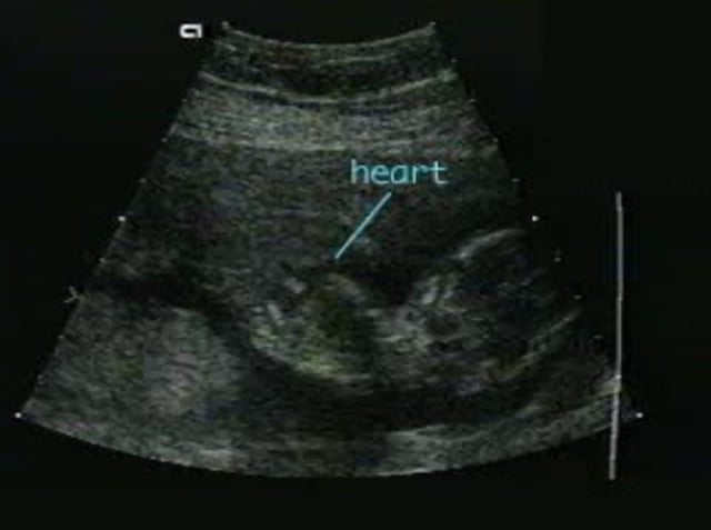 Pentalogy of Cantrell – ULTRASOUNDPAEDIA