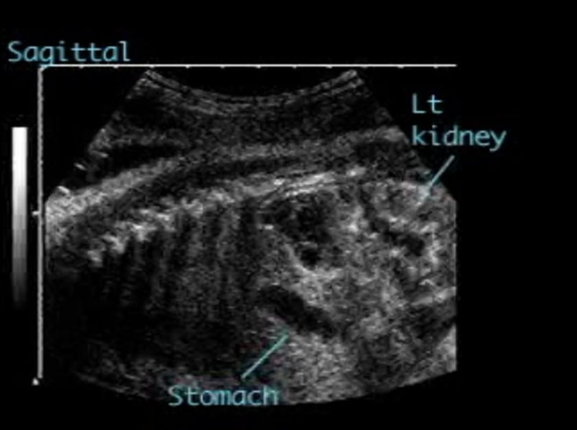 Splenic cyst – ULTRASOUNDPAEDIA