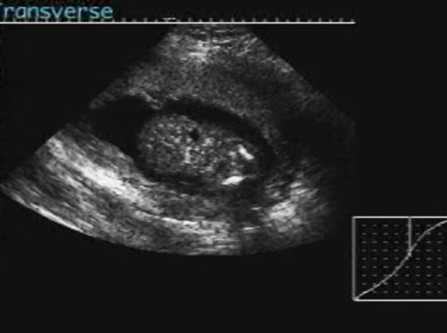 Thoracoabdominal eventration – ULTRASOUNDPAEDIA