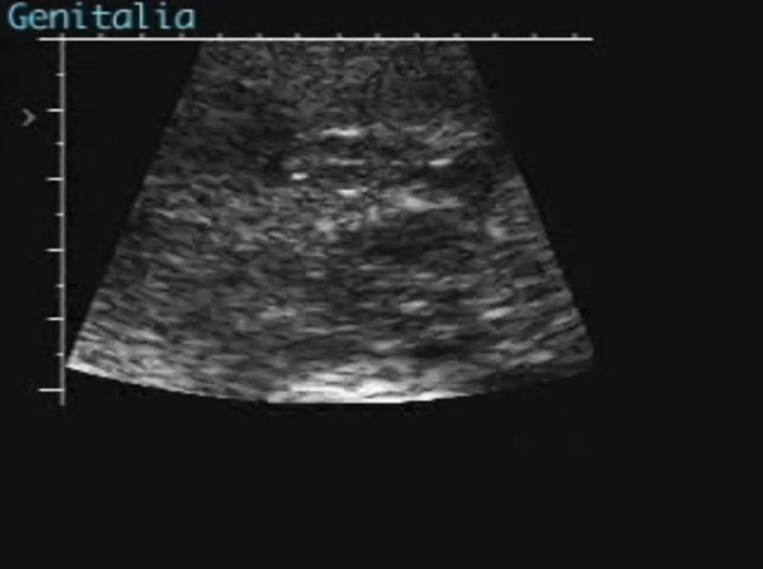 Ambiguous genitalia – ULTRASOUNDPAEDIA