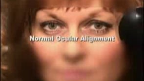 Diplopia | MedLink Neurology