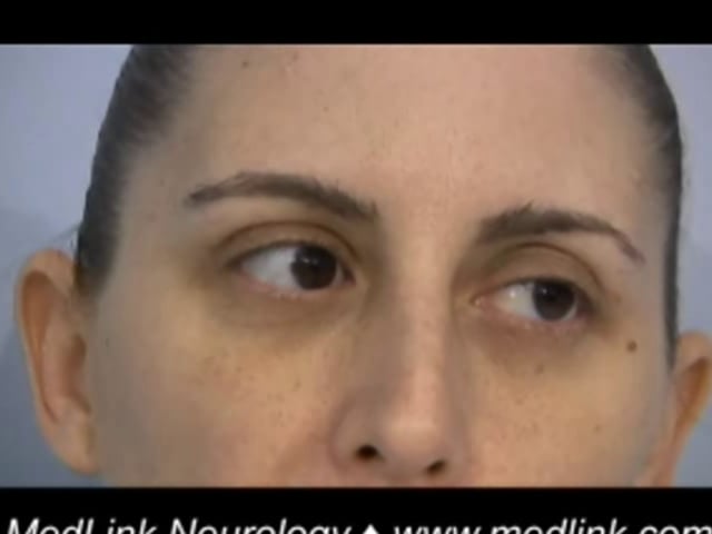 Neuro-ophthalmology of movement disorders | MedLink Neurology