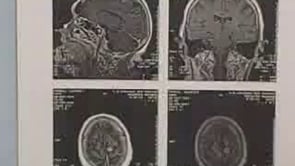 Functional parkinsonism with tremor and slowed gait | MedLink Neurology