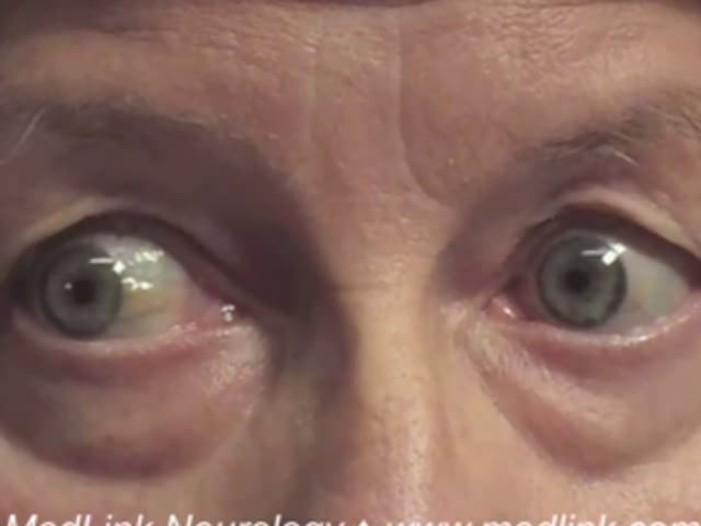 Vertical gaze palsy | MedLink Neurology