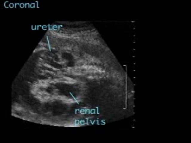 Posterior urethral valves – ULTRASOUNDPAEDIA