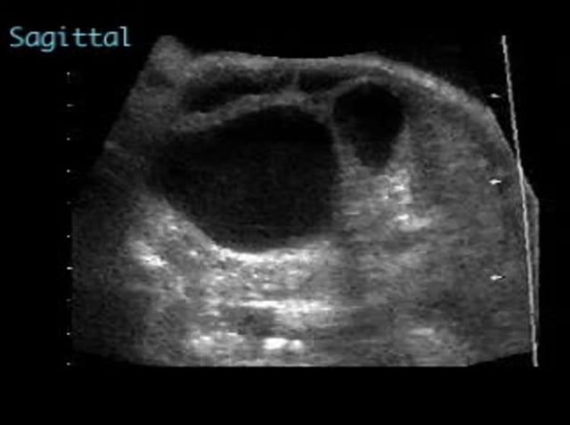 Hydrometrocolpos – ULTRASOUNDPAEDIA