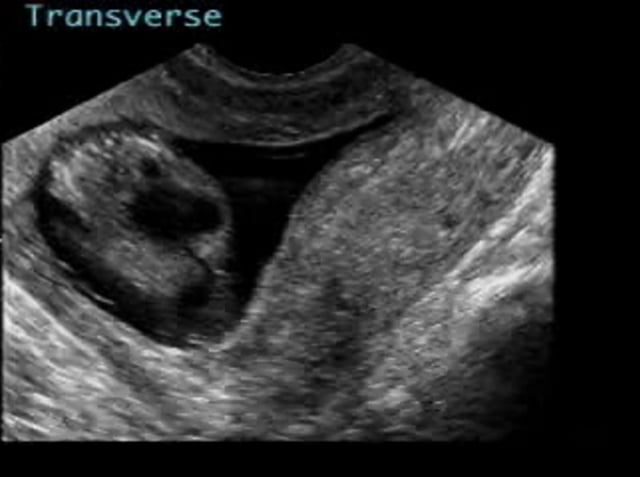 Megacystis – ULTRASOUNDPAEDIA