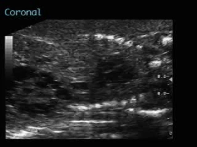 Multicystic kidney disease – ULTRASOUNDPAEDIA