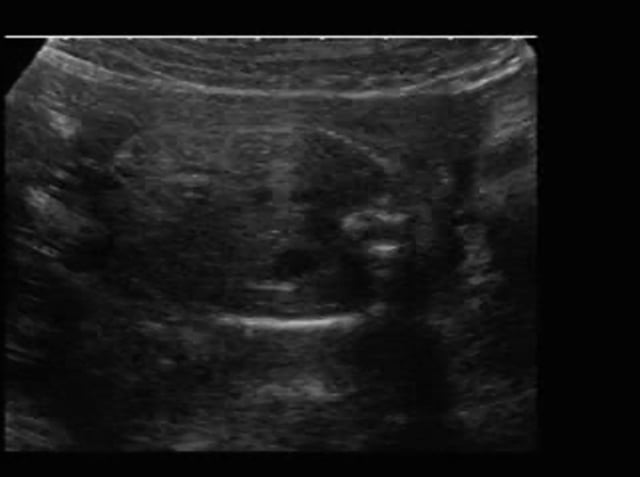 Oligohydramnios – ULTRASOUNDPAEDIA
