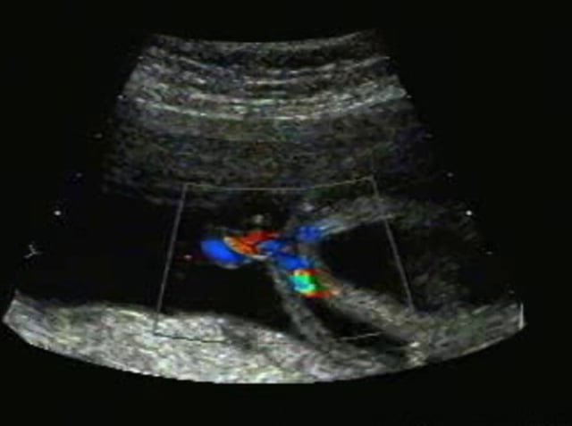Urachal abnormalities – ULTRASOUNDPAEDIA