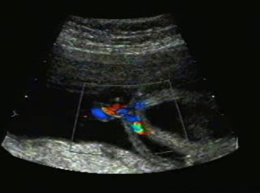 Urachal abnormalities – ULTRASOUNDPAEDIA
