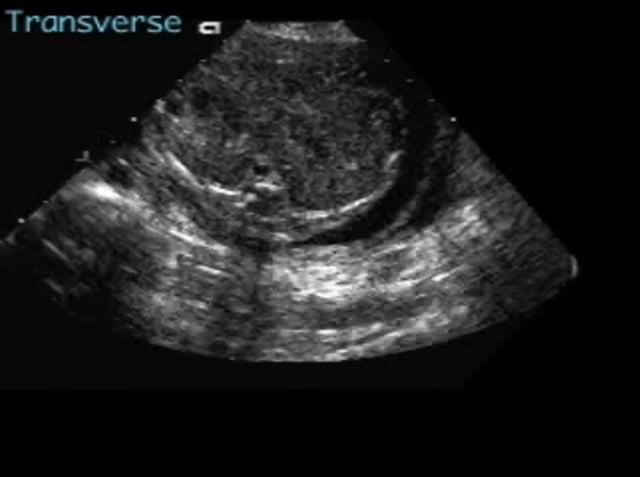 Urachal Abnormalities Ultrasoundpaedia
