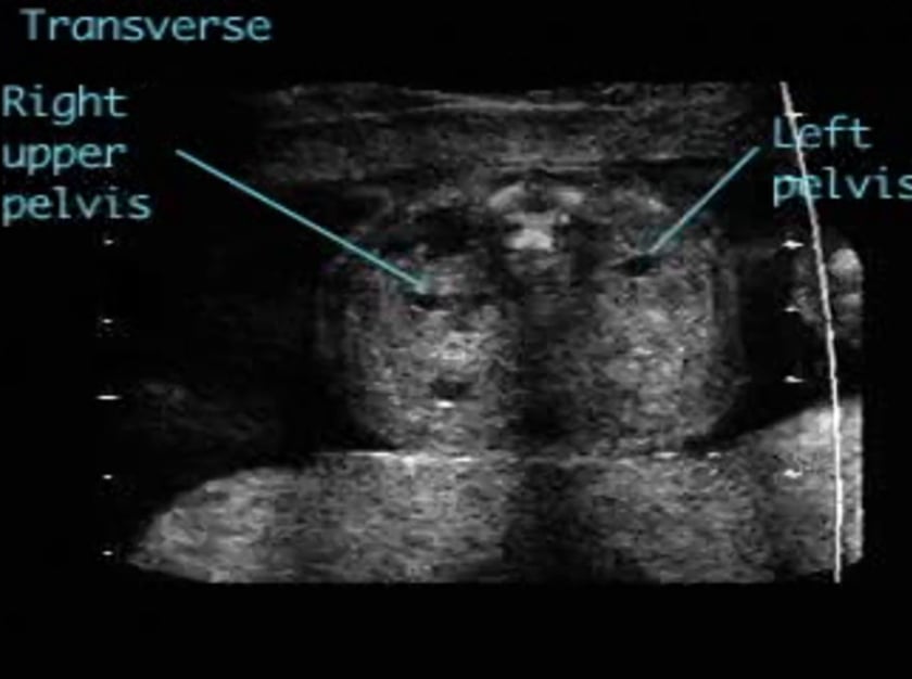 Renal duplication – ULTRASOUNDPAEDIA