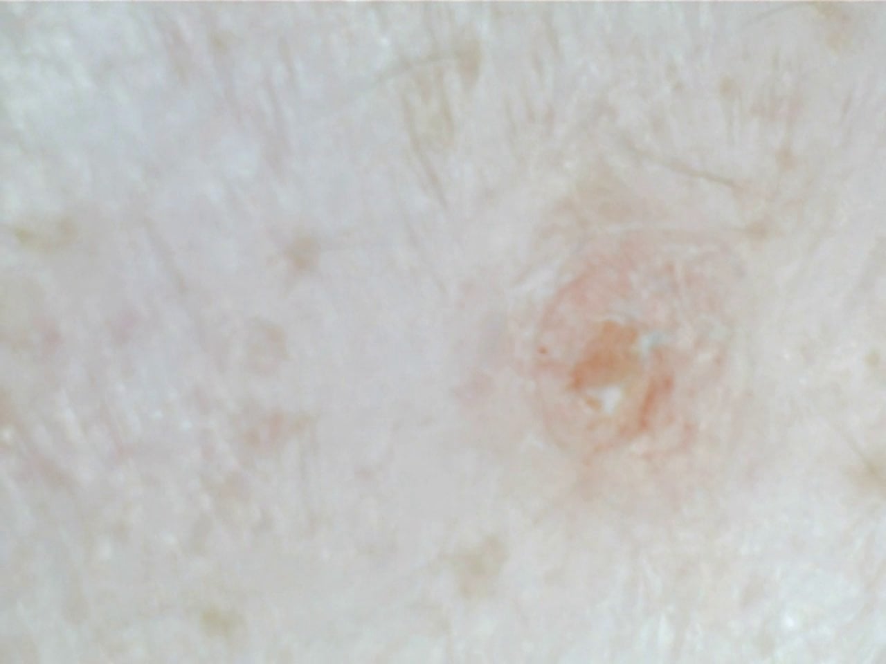 Sebum stuck on my back on Vimeo