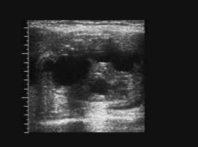 Vesicoureteral reflux – ULTRASOUNDPAEDIA