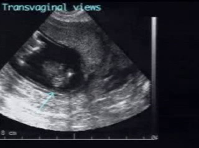 Amelia – ULTRASOUNDPAEDIA