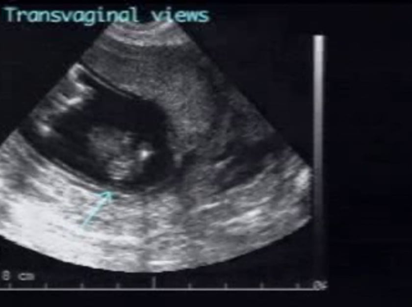 Amelia – ULTRASOUNDPAEDIA
