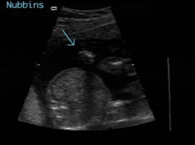 Acromesomelic dysplasia – ULTRASOUNDPAEDIA