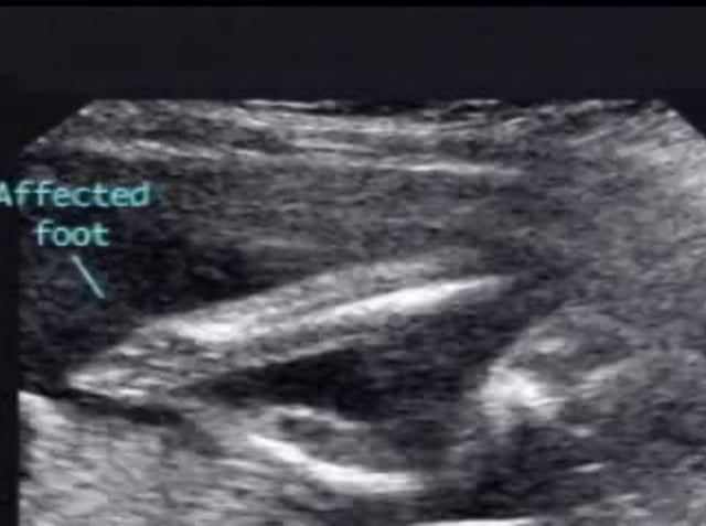 Apodia – ULTRASOUNDPAEDIA