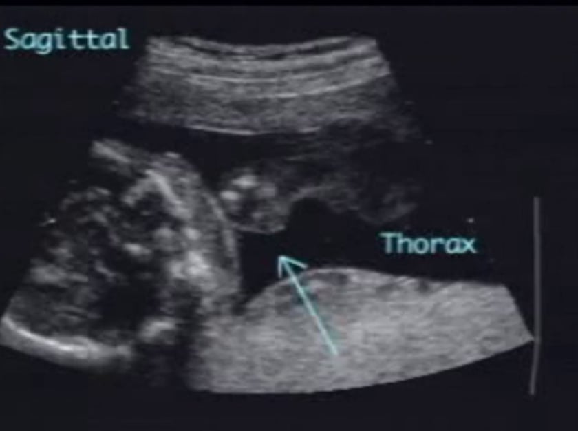 Amelia – ULTRASOUNDPAEDIA