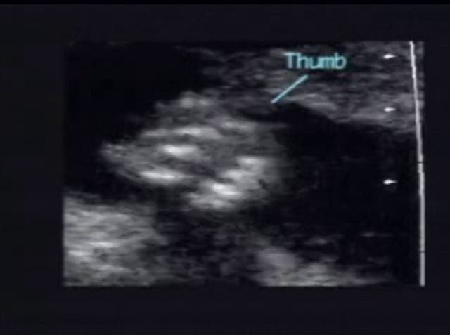 Brachydactyly – ULTRASOUNDPAEDIA