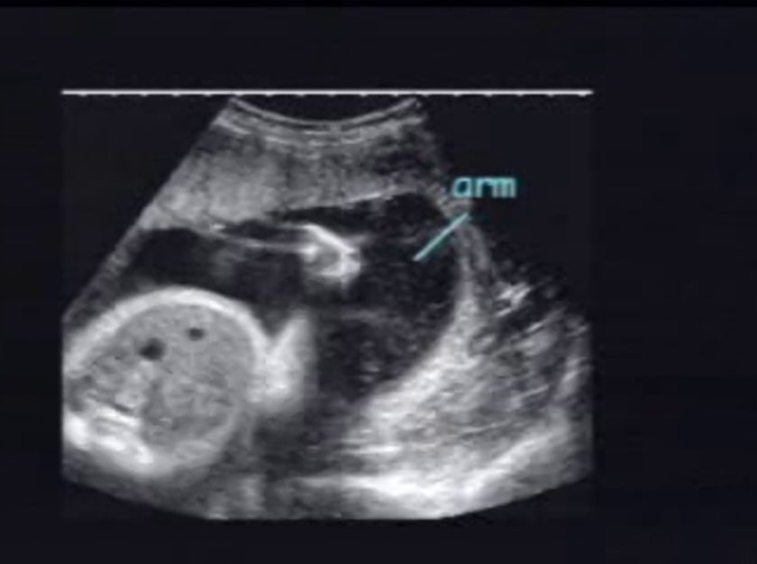 Arthrogryposis – ULTRASOUNDPAEDIA