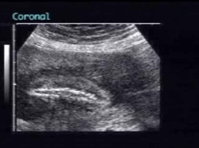 Chondrodysplasia punctata – ULTRASOUNDPAEDIA