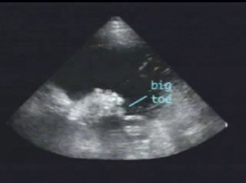 Diastrophic dysplasia – ULTRASOUNDPAEDIA
