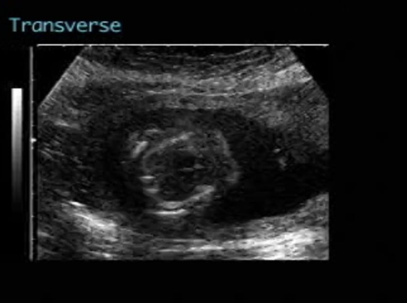 Kniest dysplasia – ULTRASOUNDPAEDIA