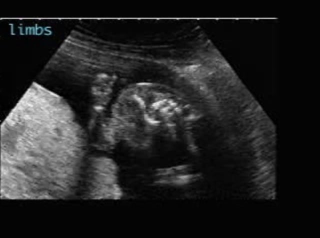 Body stalk anomaly – ULTRASOUNDPAEDIA