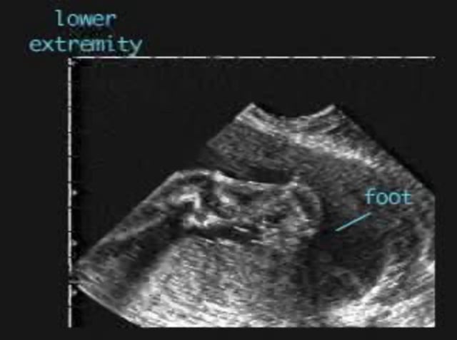 Meromelia – ULTRASOUNDPAEDIA