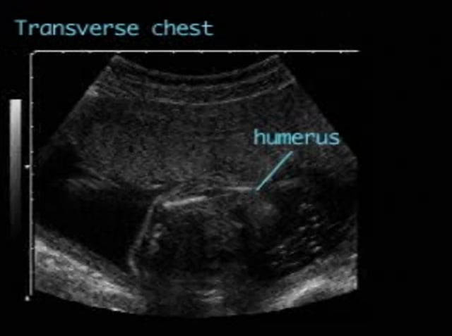 Meromelia – ULTRASOUNDPAEDIA