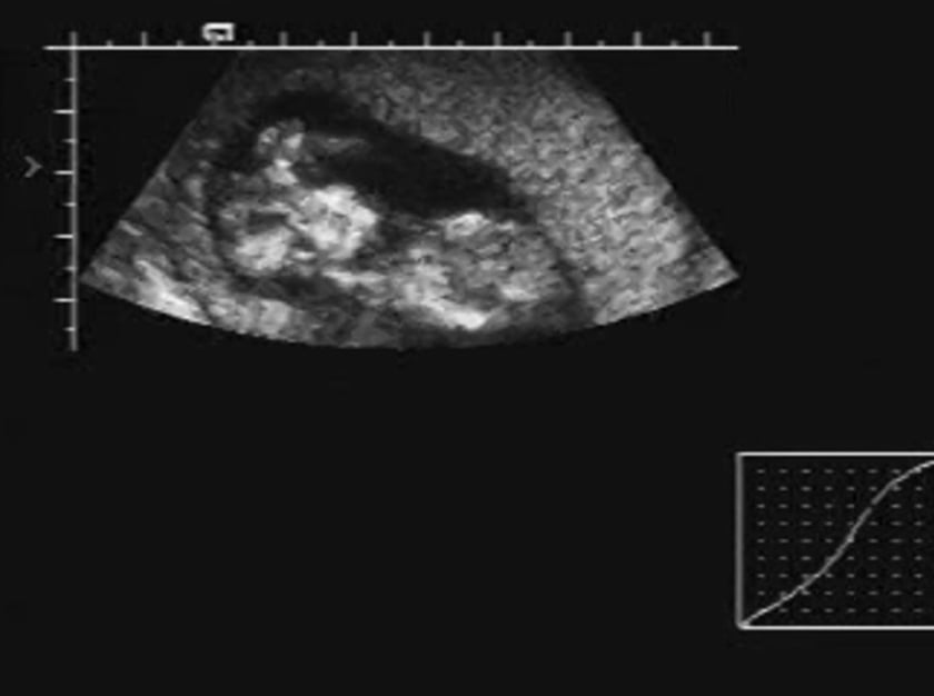 Polydactyly – ULTRASOUNDPAEDIA