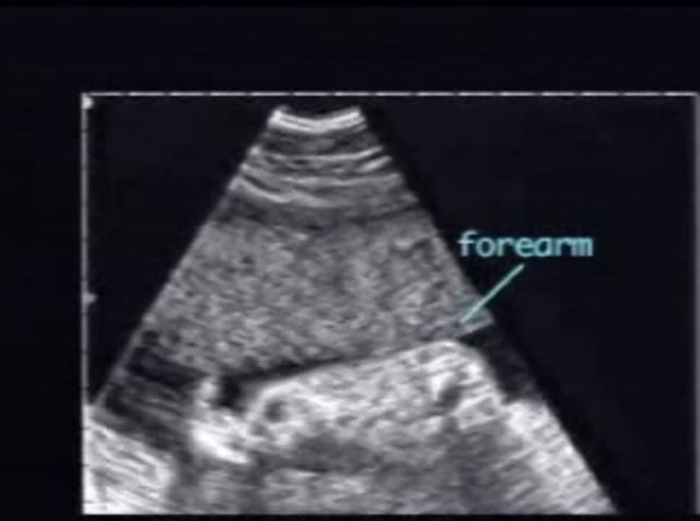 Radial ray defects – ULTRASOUNDPAEDIA