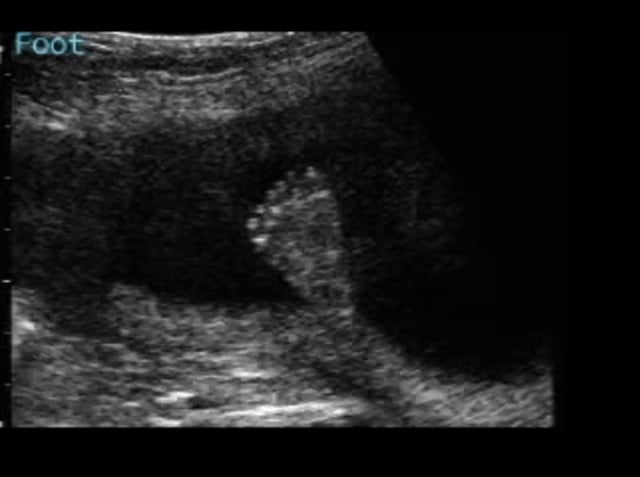 Polydactyly – ULTRASOUNDPAEDIA